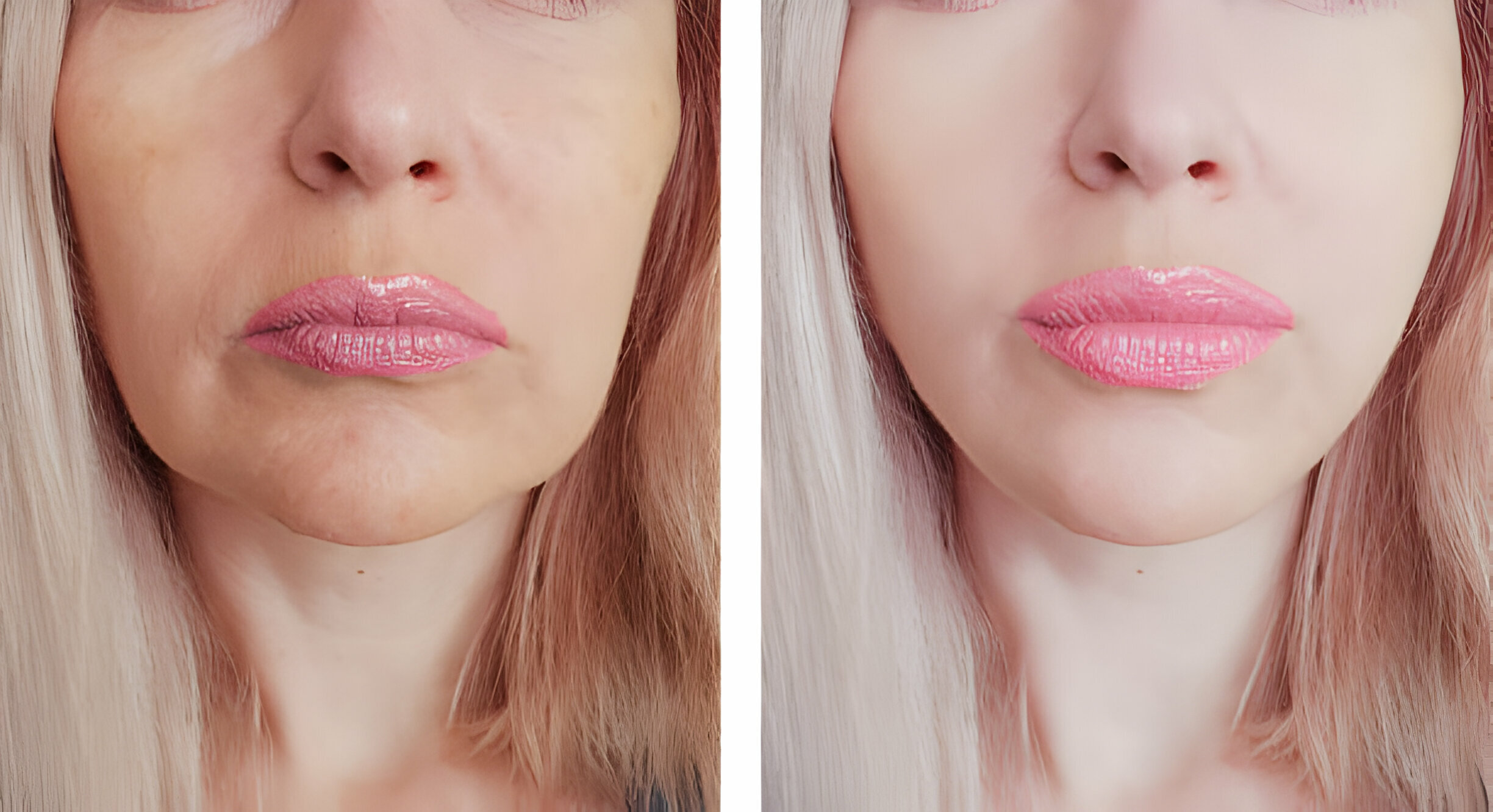 Masseter Botox: Before and After Marvels - BotoxMelbourne.com