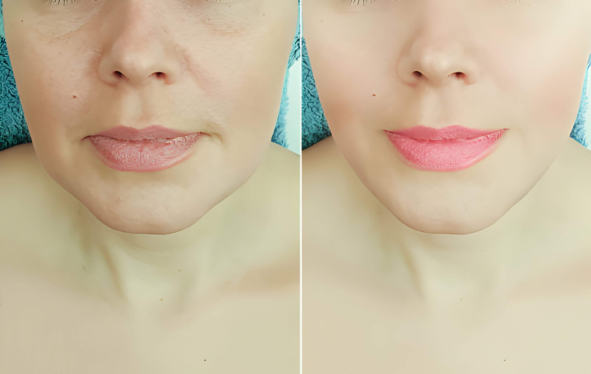 Masseter Botox: Before and After Marvels - BotoxMelbourne.com